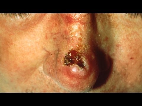 What Is Squamous Cell Carcinoma? | Skin Cancer
