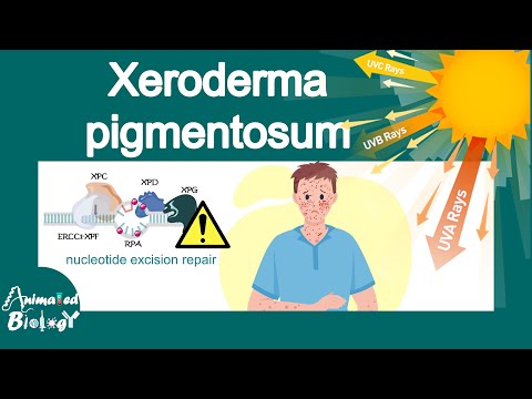 Xeroderma pigmentosum | What is the main cause of xeroderma pigmentosum? | treatment of XP | USMLE