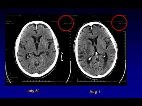Imaging of Stroke CT and MRI