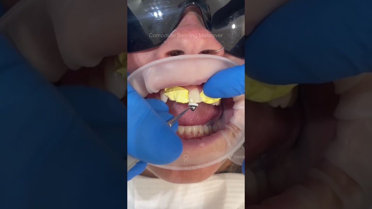Composite bonding on the upper 6 teeth to improve shapes & lengths of the teeth ✨
