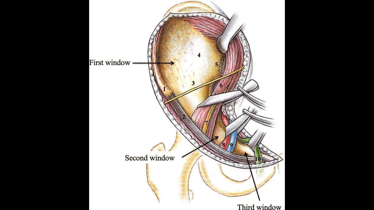 Ilioinguinal Approach to the Pelvis.