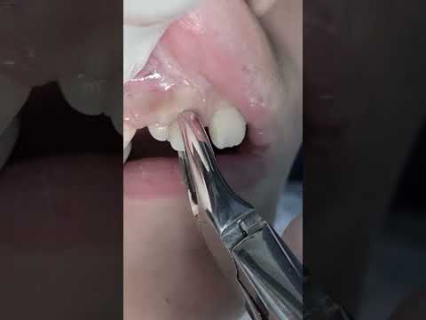 Extraction of deciduous tooth ( A ) #dentistry