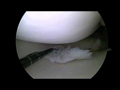 Arthroscopic Partial Medial Meniscectomy