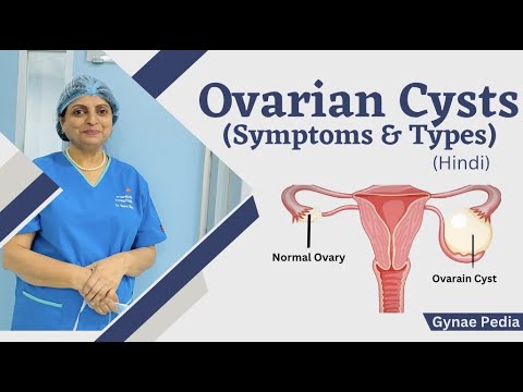 What are Ovarian Cysts: Symptoms and Types | क्या है ओवेरियन सिस्ट ? Hindi | Dr Neera Bhan
