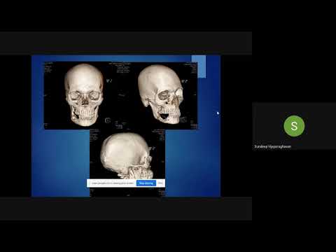 Plastiquest Case Discussion-Ameloblastoma Mandible 1