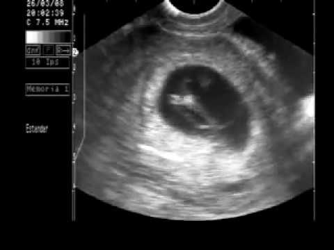 Embrión de 8 semanas | Blog del Dr. Santiago Díaz Risco