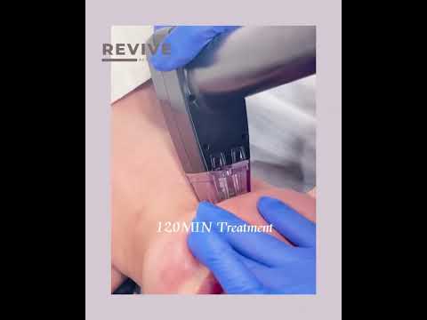 Inmode Morpheus8 treatment at Revive Aesthetic Clinic