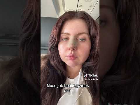 NOSE JOB RESULT (TIPPLASTY)