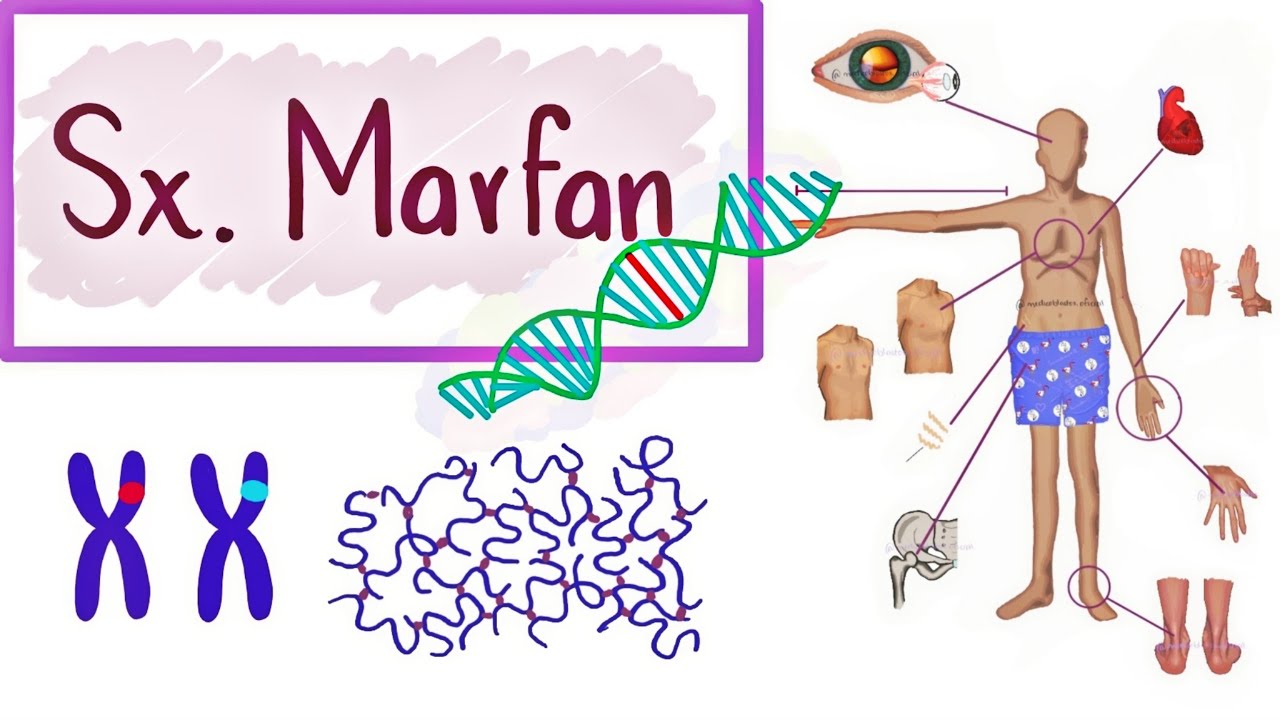 ¿qué Características Presenta El Síndrome De Marfan Lib Ask