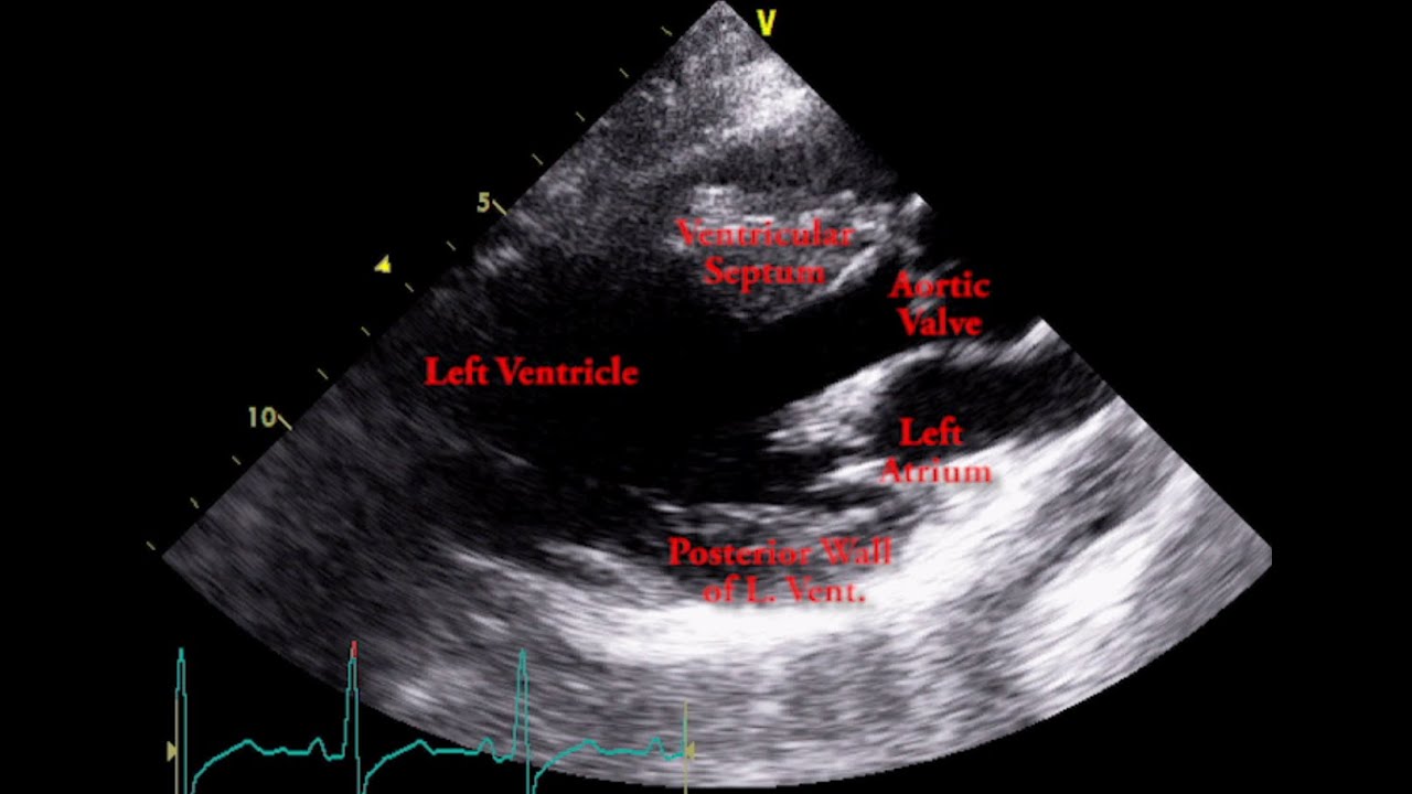 Aortic Stenosis Parasternal Long Axis - Loop