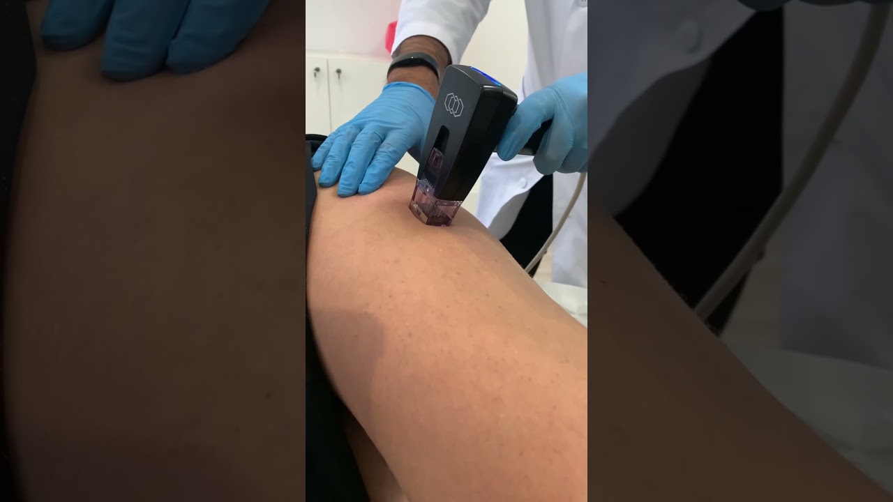 Buttocks and legs cellulite reduction with Morpheus 8