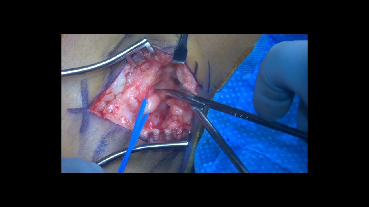 Nerve Decompression Surgery: Common Peroneal Nerve Decompression