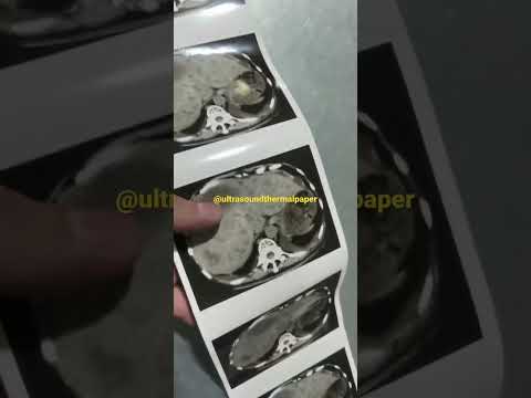 UPP-110HG Ultrasound Thermal Print Media Performance - Glossy Paper Like Mirror