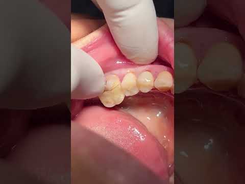 Fracture of root canal treated tooth #dentist
