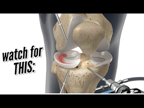 Meniscus Repair vs Meniscectomy