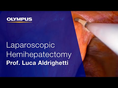 Laparoscopic Hemihepatectomy | THUNDERBEAT | Prof. Luca Aldrighetti