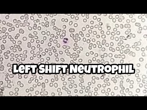 Left Shift Neutrophil or Bend Neutrophil in CBC Slide | In My Hematology Section | Rbc Morphology