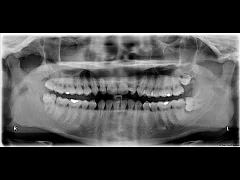 FDI World Dental Federation notation | Wikipedia audio article