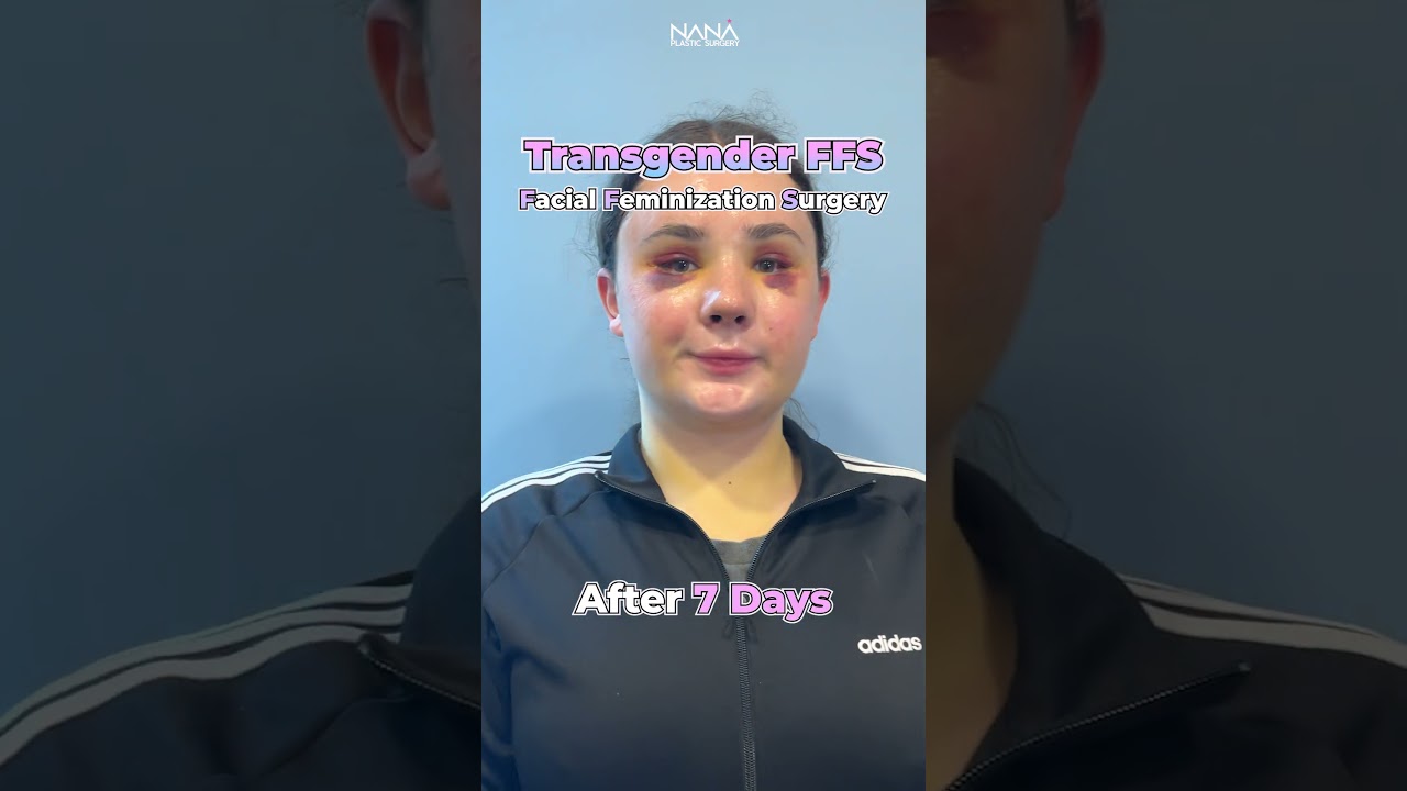 Facial Feminization Surgery: Real Results Before & After | NANA Hospital Korea