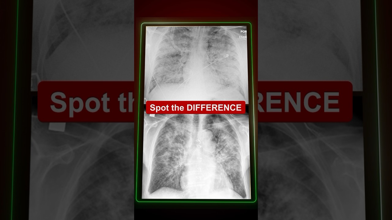 Spot the difference in these 2 Chest X-rays #icu #emergency #xray