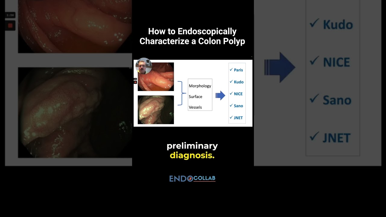 How to Endoscopically Characterize a Colon Polyp