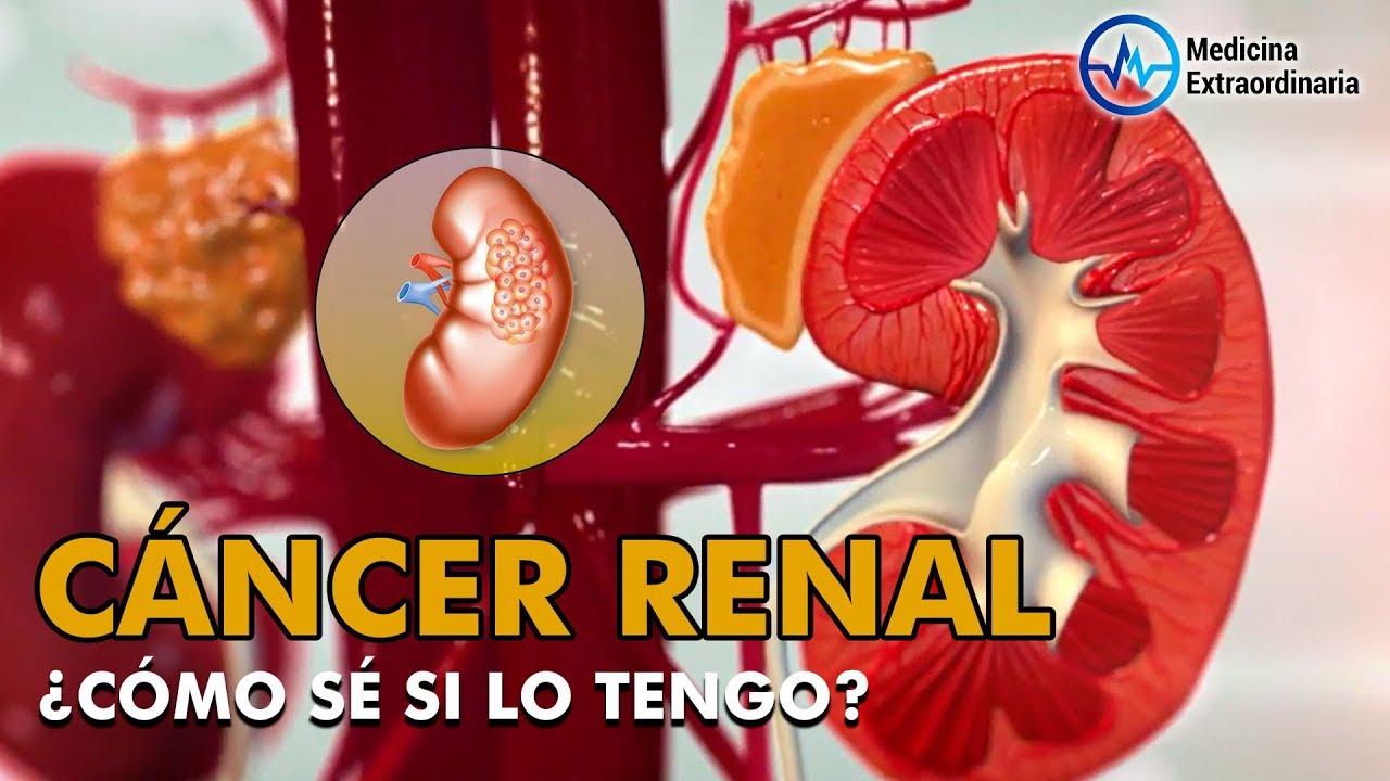 CÁNCER RENAL 🏥 CAUSAS, PREVENCIÓN, DIAGNÓSTICO Y TRATAMIENTO *** UROZEN CLÍNICA DE UROLOGÍA AVANZADA