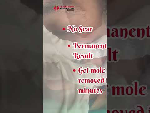 Mole Removed In 10 Minutes