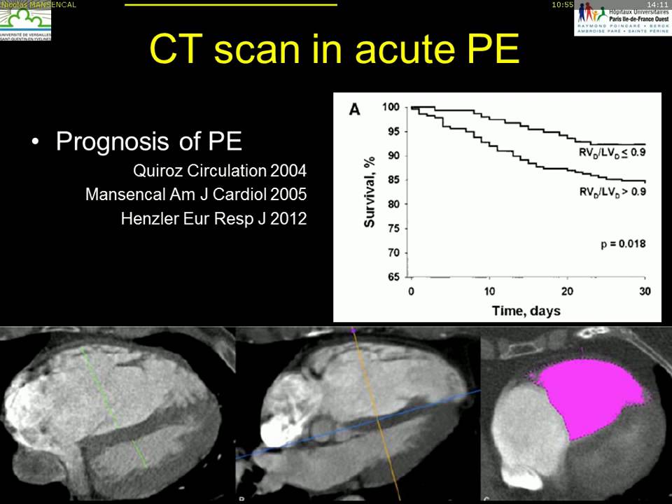 Pulmonary embolism: echo in all?