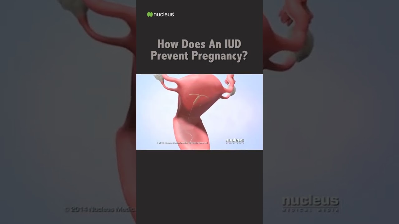 How Does An IUD Prevent Pregnancy? #shorts