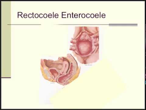 DAROGA Pelvic Organ Prolapse Part One