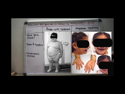 Disorders of Imprinting | Prader-Willi Syndrome and Angelman Syndrome | USMLE step 1 | Lecture 4