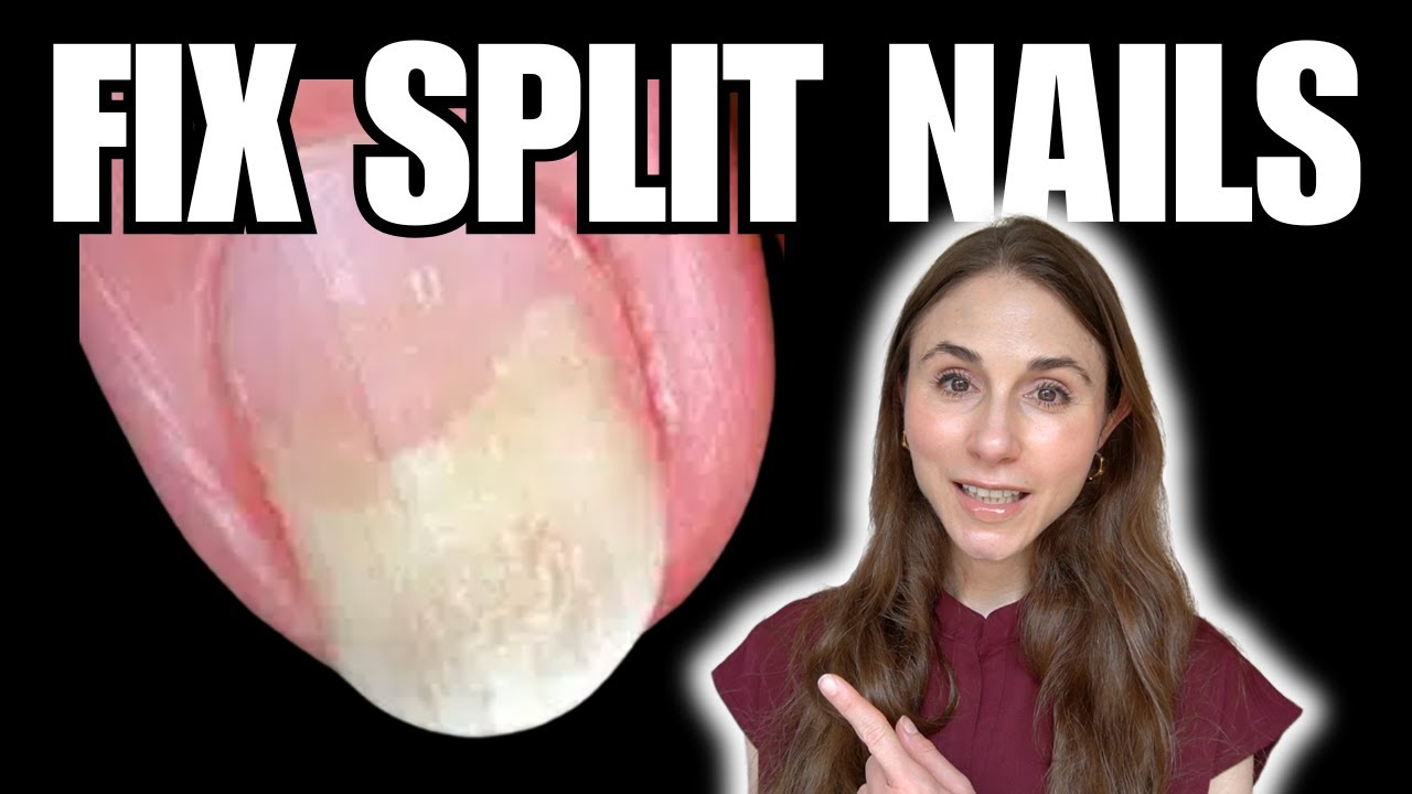 How To Fix Nail Splitting | Onycholysis