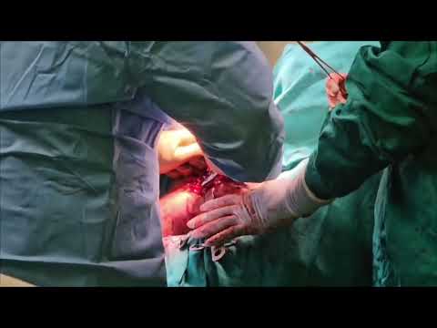 Proximal Humerus Fracture Surgery