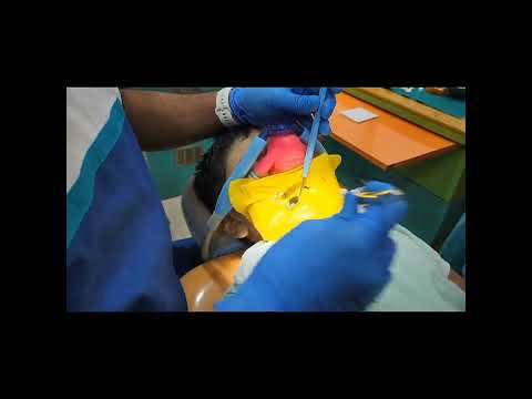 Quadrant dentistry in 4 yr old under NOIS anaged the child in 4 appointmentsGreetings