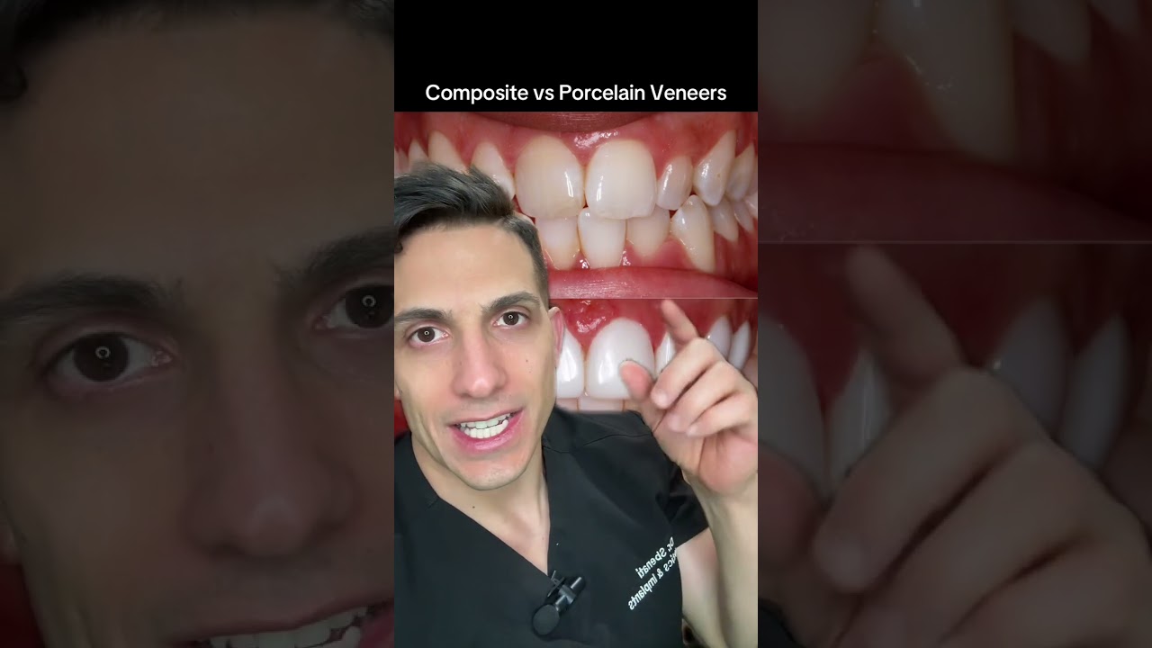 Porcelain veneers are MUCH better than composite veneers