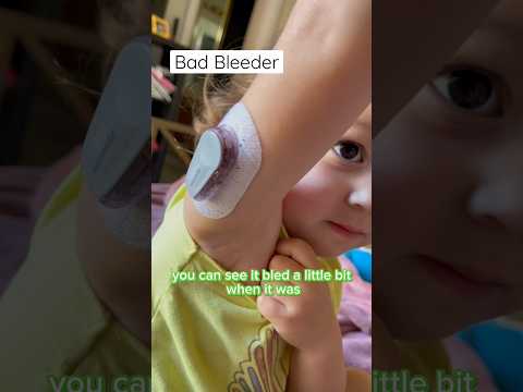DEXCOM SENSOR WAS A GOOD BLEEDER! #TYPE1DIABETES #DEXCOM