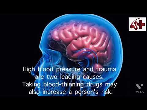 Hemorrhagic stroke.#CVA.# ICH. #Brain Hemorrhage