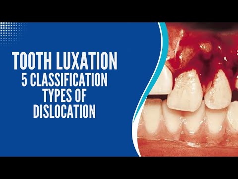 Tooth Luxation: 5 Classification Types of Dislocation