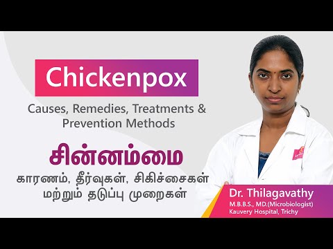 Chicken Pox - Symptoms, Causes, Prevention, Treatment & Awareness