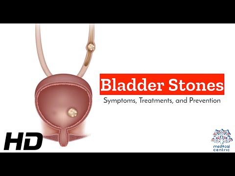 Bladder Stones : Symptoms, and Your Path to Relief