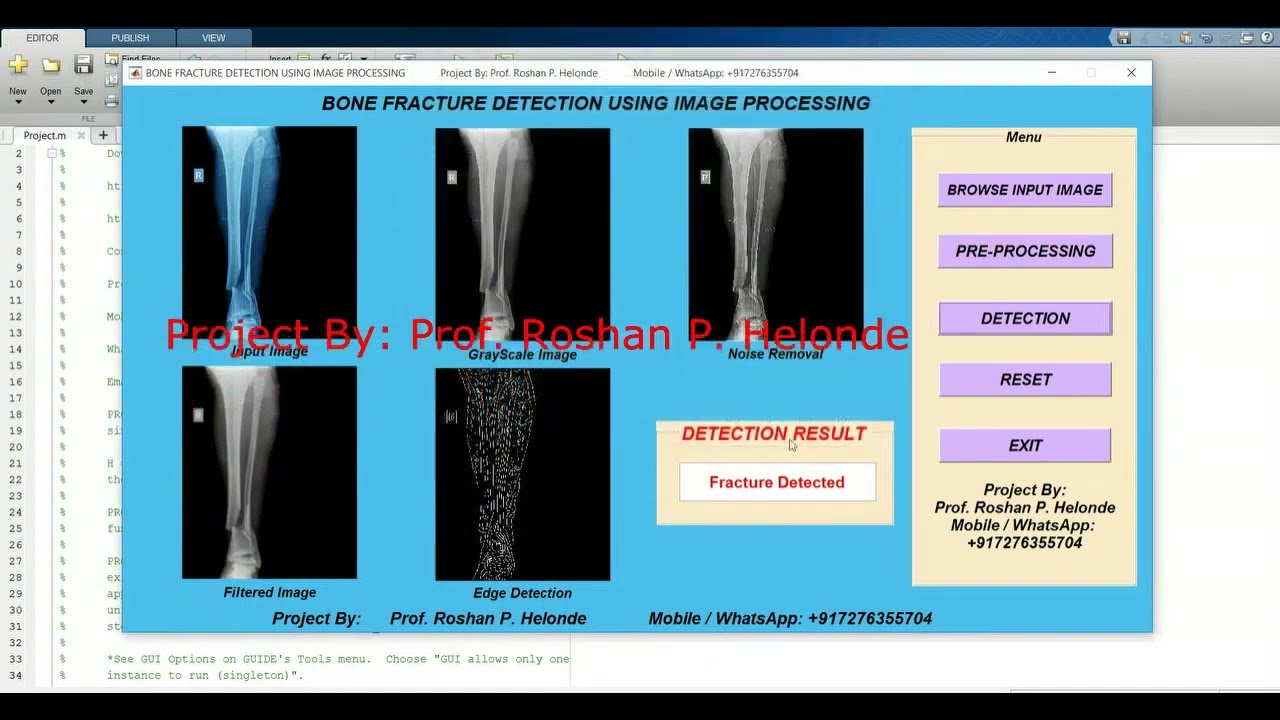 Detection Of Bone Fracture Using Image Processing Matlab Project With Source Code Fracture Detection