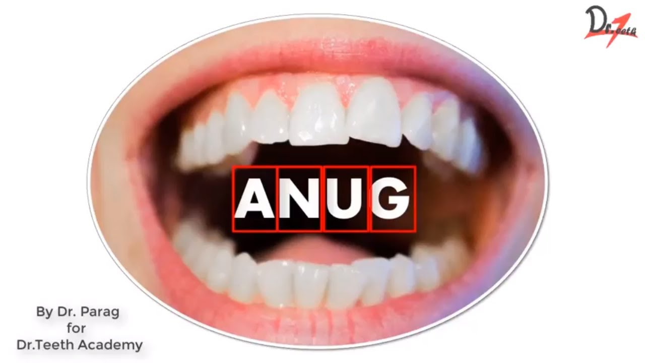 ANUG | Acute necrotizing ulcerative gingivitis |