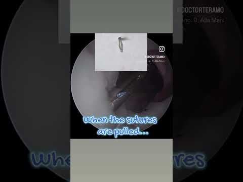 How an all-suture anchor works: I use it for labral repair in shoulder arthroscopy. #orthopedics