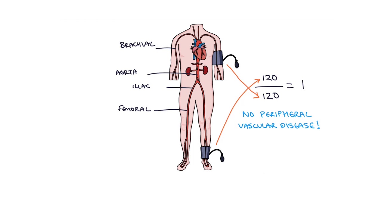 Understanding Ankle Brachial Pressure Index (ABPI) in Peripheral Vascular Disease
