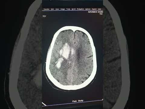 CTSCAN HEAD Acute intraparenchymal hemorrhage in right capsuloganglionic region