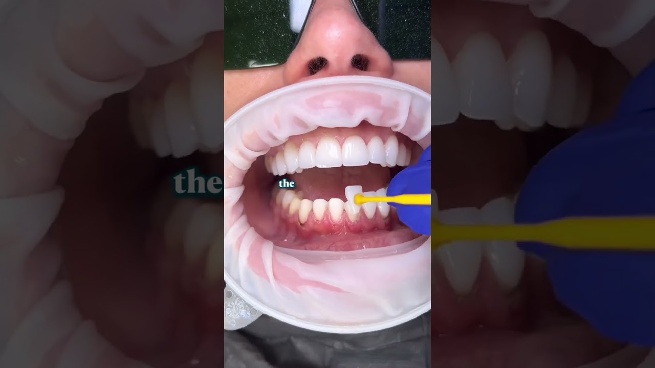 From Composite to Porcelain Veneers 🦷 #dentist #qanda #veneers #composite #porcelain #explained