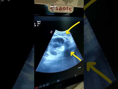 Ultrasound of Renal Ectopia(Crossed ectopic Kidney)💯