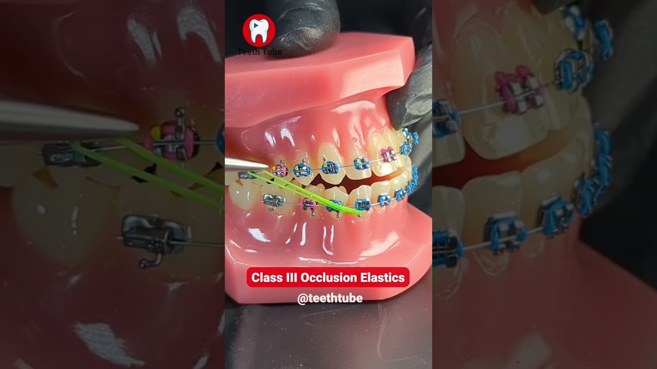 Class III Occlusion Elastics #shorts