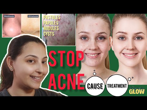 Types of Acne Explained | Real Causes, Best Treatments & Prevention Tips | Doctor K