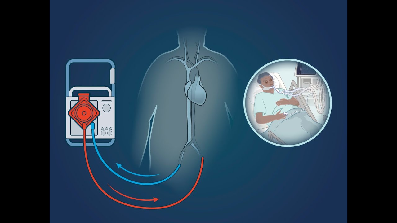 Extracorporeal CPR for Refractory Out-of-Hospital Cardiac Arrest | NEJM